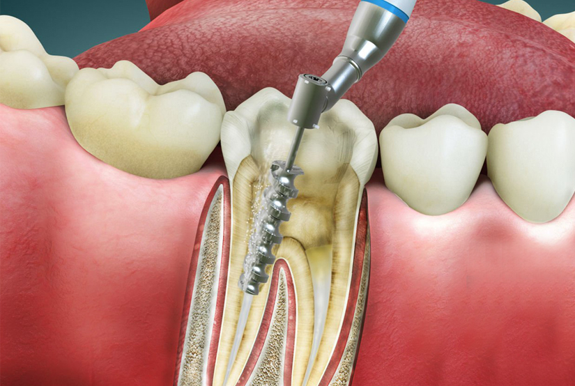 Root Canal Treatment in London, Ontario